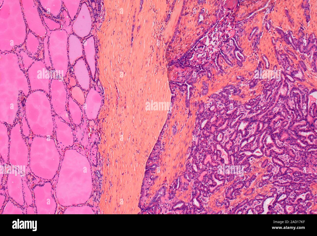 Thyroid cancer. Light micrograph of a section through a thyroid gland ...