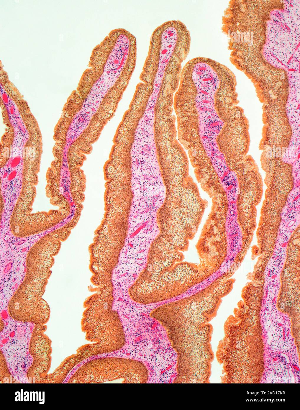 Nasal papilloma. Light micrograph of a section through affected nasal ...