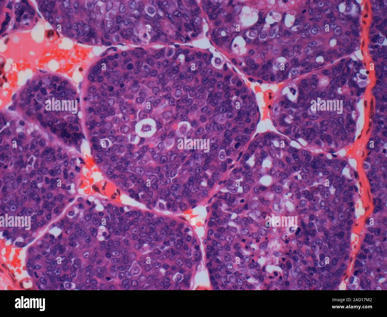 Bladder cancer. Light micrograph of a section through a transitional ...