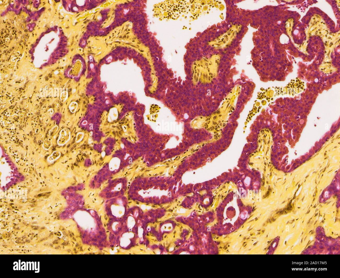 Bladder cancer. Light micrograph of a section through a transitional ...