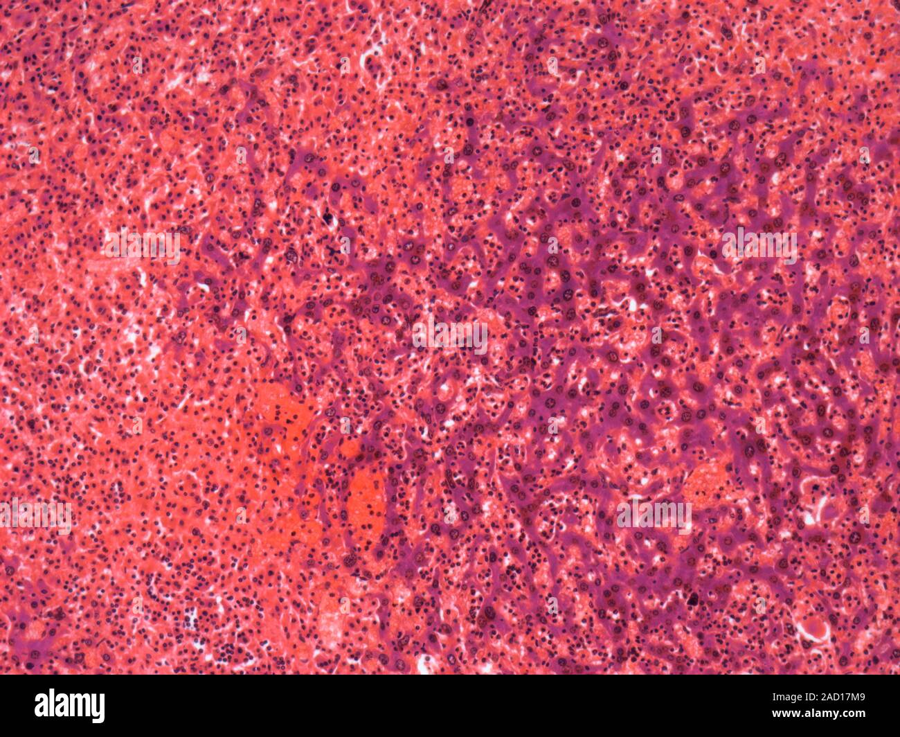 Liver cancer. Light micrograph of a section through a histiocytic ...