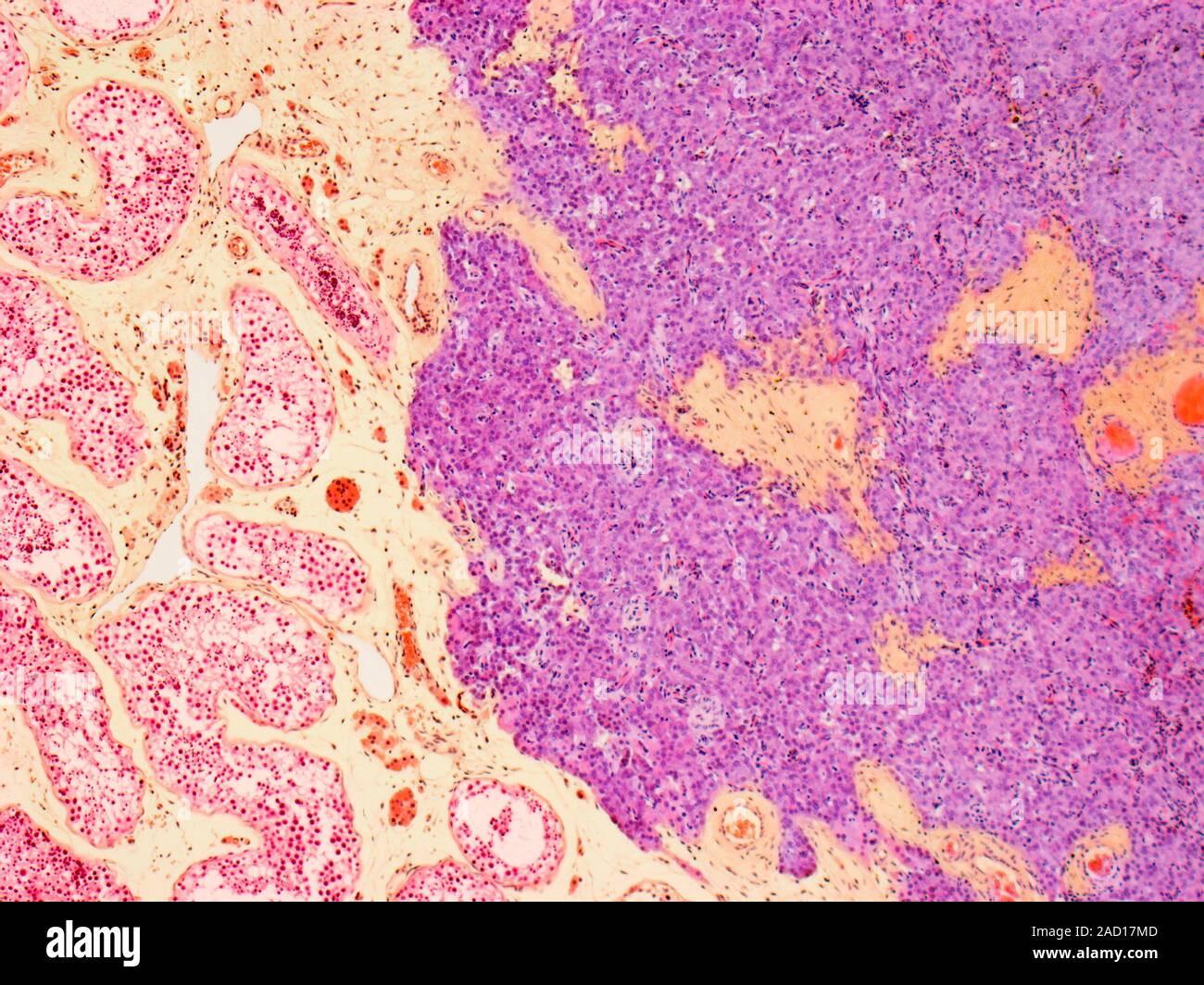 Leydig Cell Tumor Of The Testis Light Micrograph Lm Of A Section