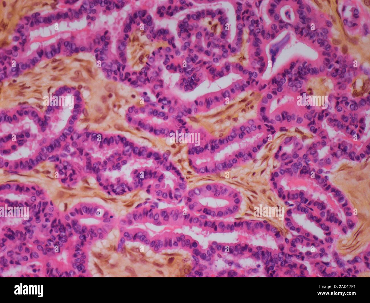 Thyroid cancer. Light micrograph of a section through a thyroid gland ...