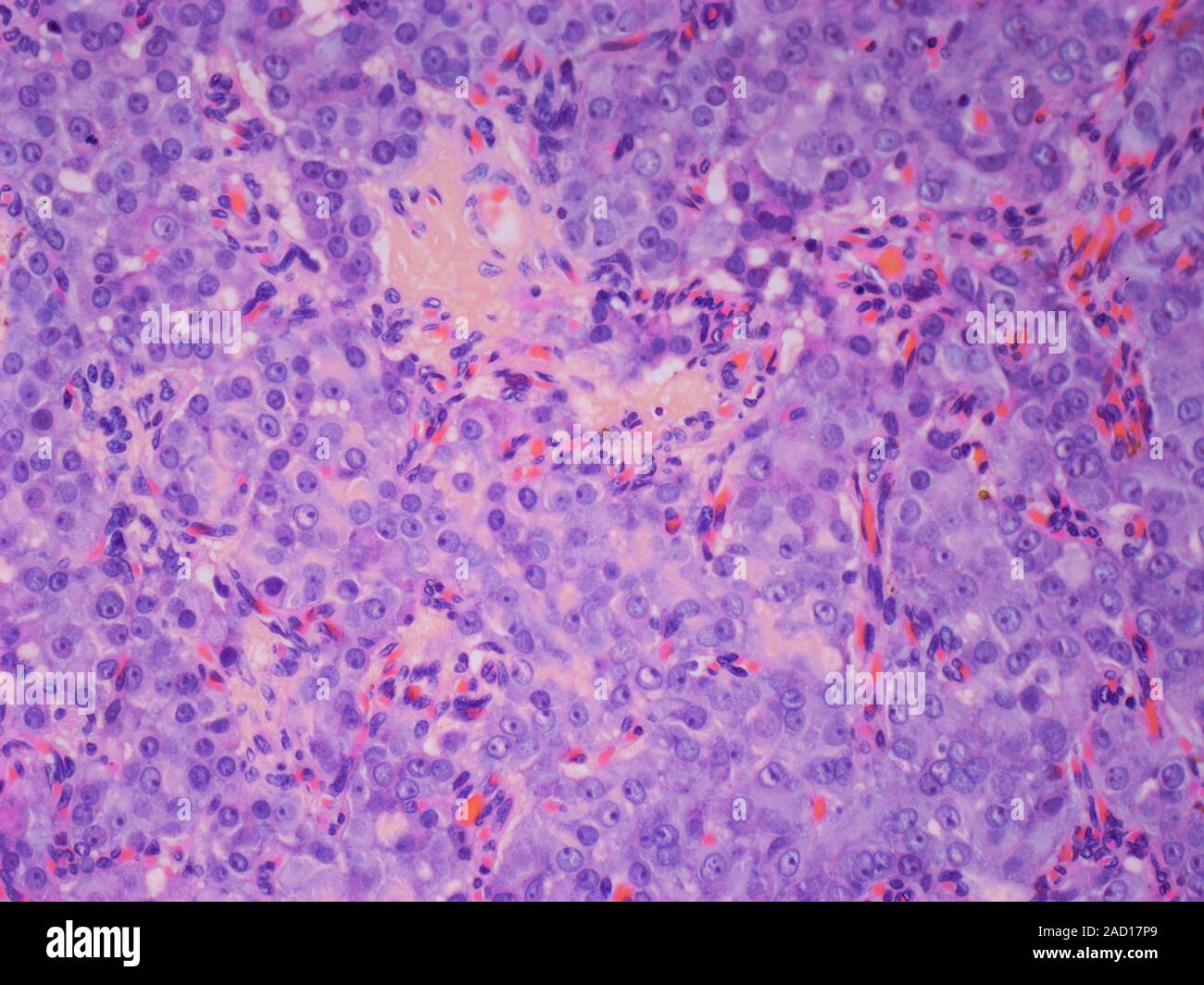 Leydig Cell Tumor Of The Testis Light Micrograph Lm Of A Section
