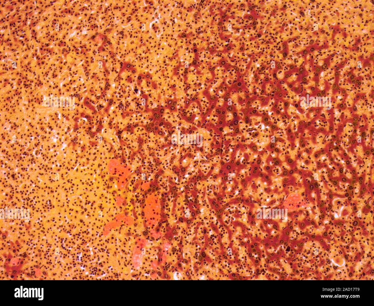 Liver cancer. Light micrograph of a section through a histiocytic ...