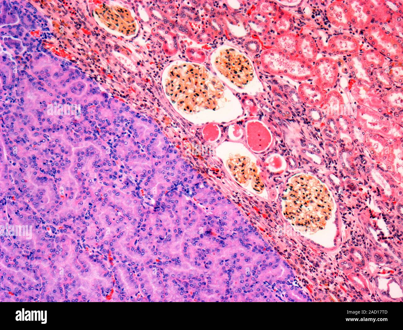 Kidney cancer. Light micrograph (LM) from a kidney affected with ...
