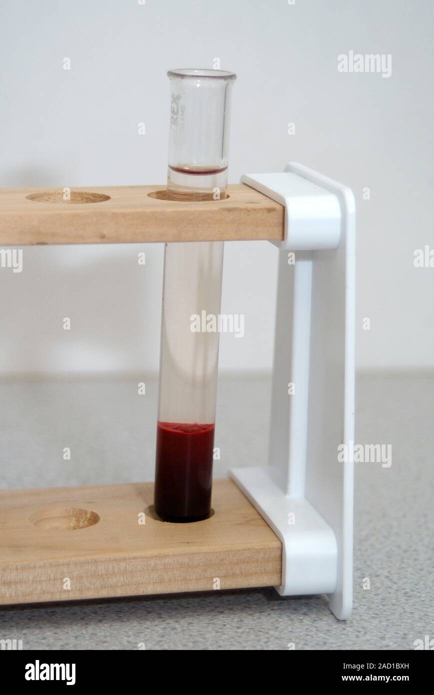Separated blood sample. Sample of blood in a test tube after being ...