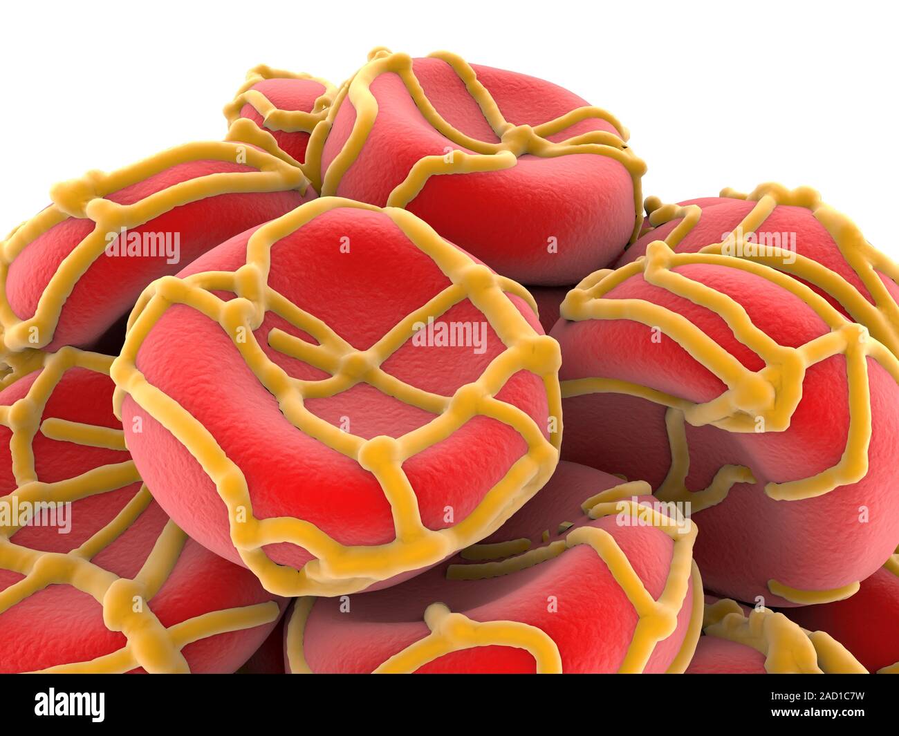 Blood clot. Computer artwork of red blood cells (erythrocytes) trapped ...