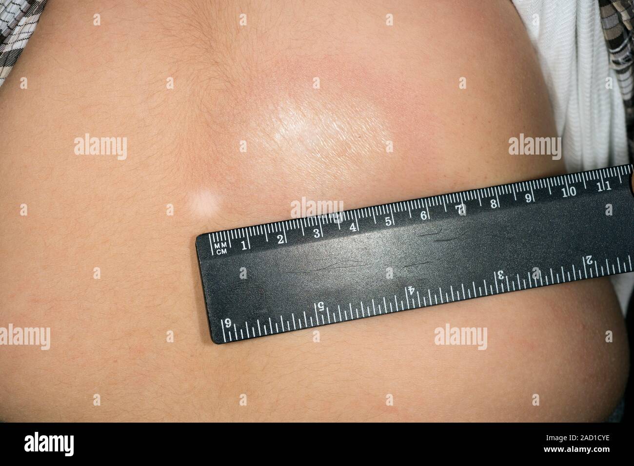 Scleroderma Plaque Ruler Showing The Size Of A Patch Plaque On The