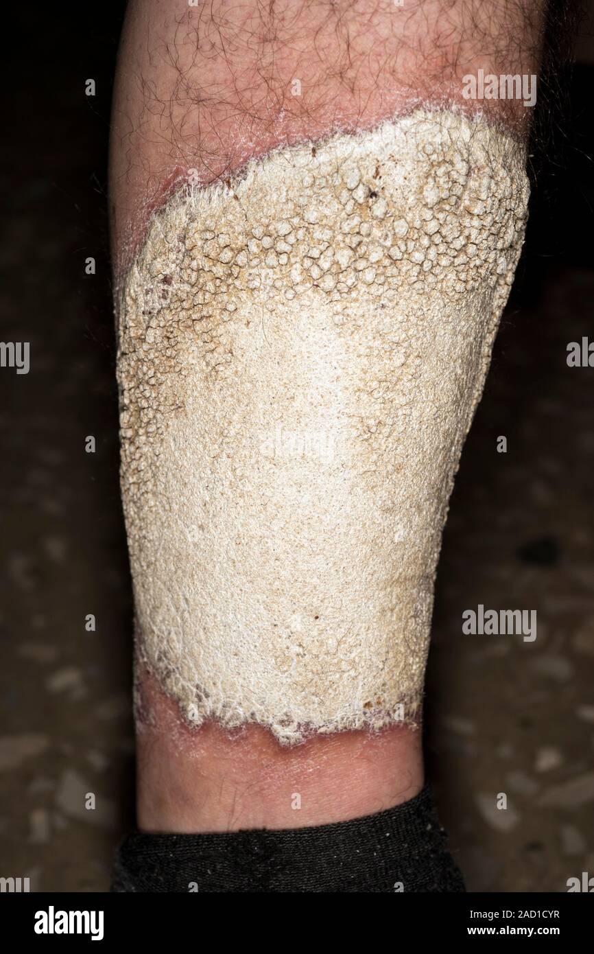 Ostraceous psoriasis. Patch of scaly psoriatic skin on the front of a ...