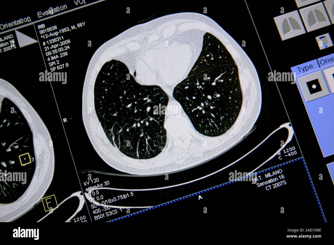 Axial lung CT scan. Axial computed tomography (CT) scan through a patient's chest, showing their ...