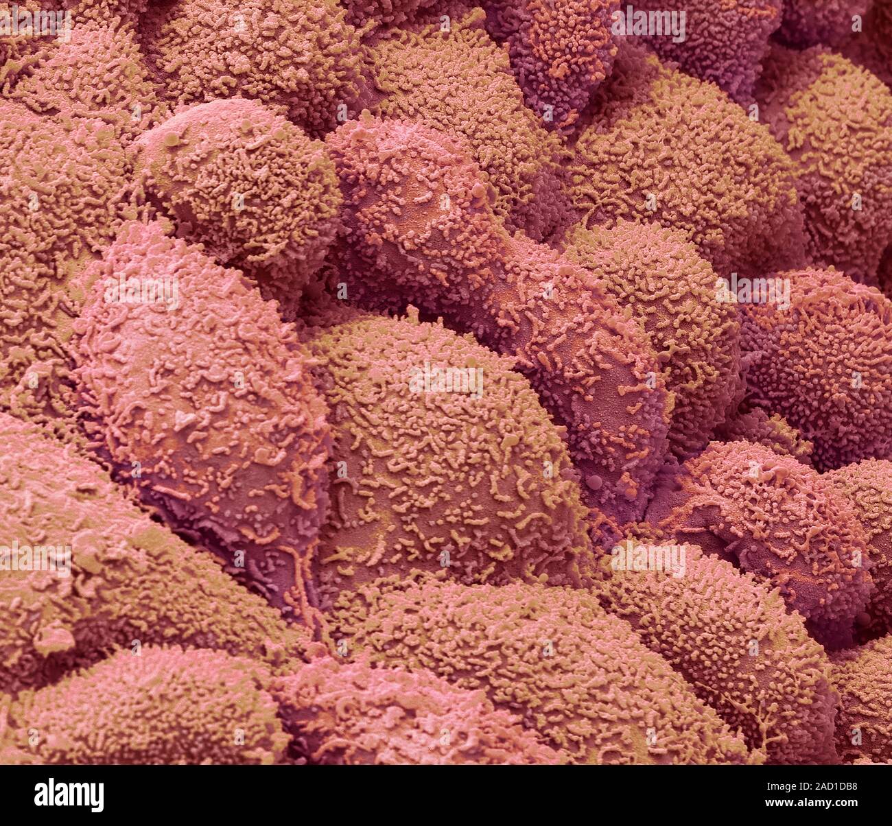 Post menopausal uterus. Coloured scanning electron micrograph (SEM) of ...