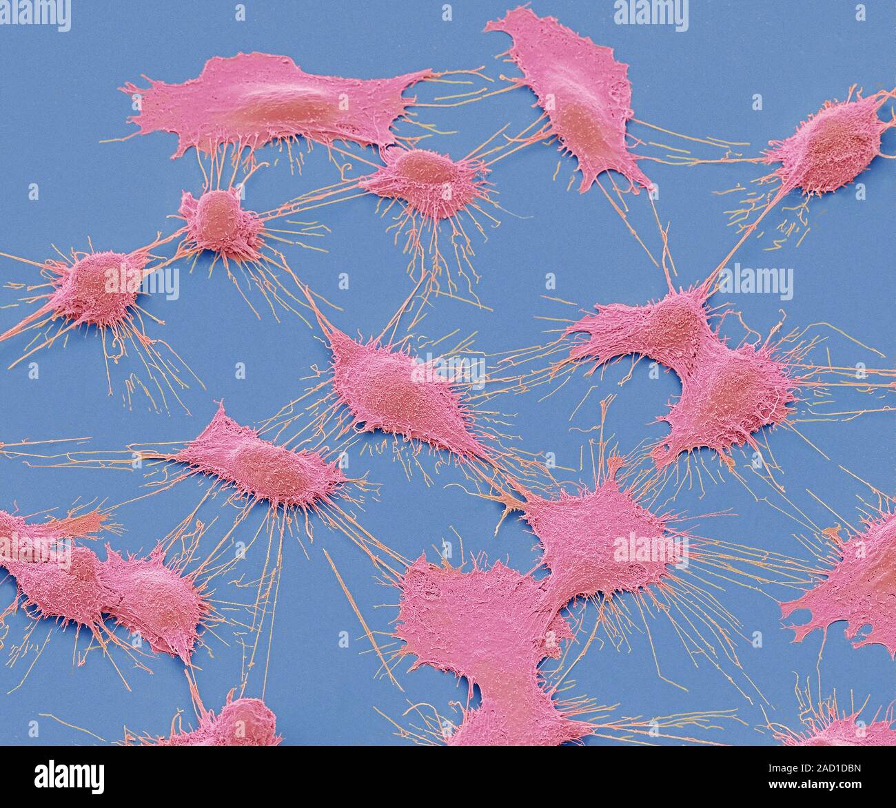Prostate cancer cells, Coloured scanning electron micrograph (SEM ... Prostate cancer cells, Coloured scanning electron micrograph (SEM ...