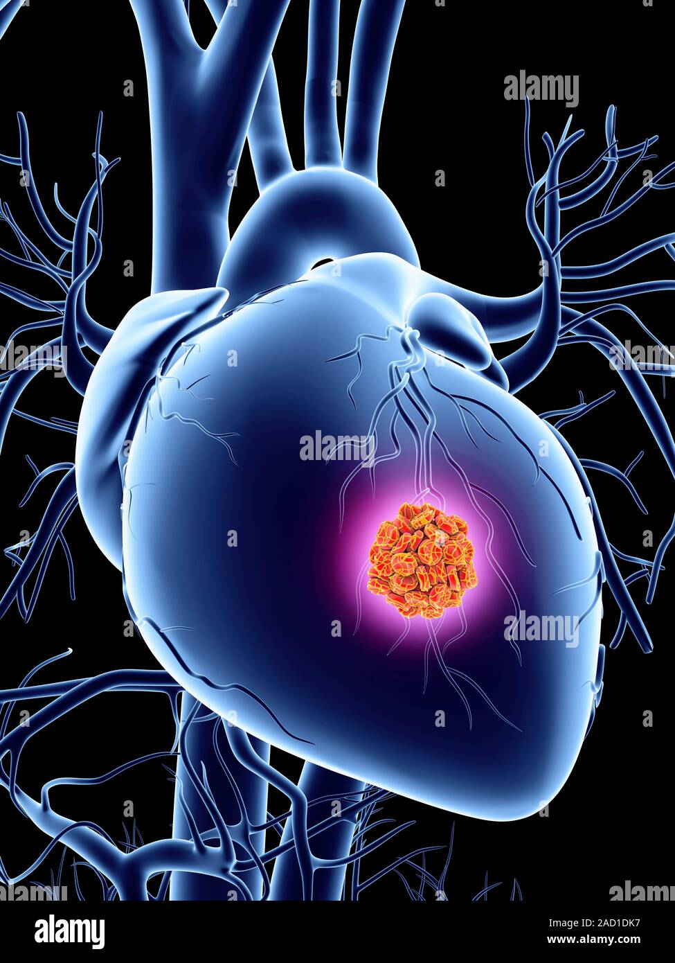 Conceptual computer artwork of a heart attack, caused by a blood clot ...