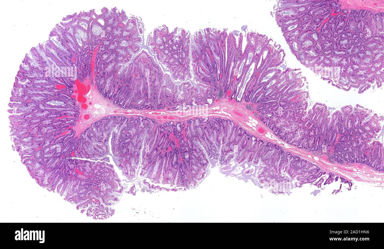 Light microscopy of a tumour of the human large bowel. This is a polyp ...