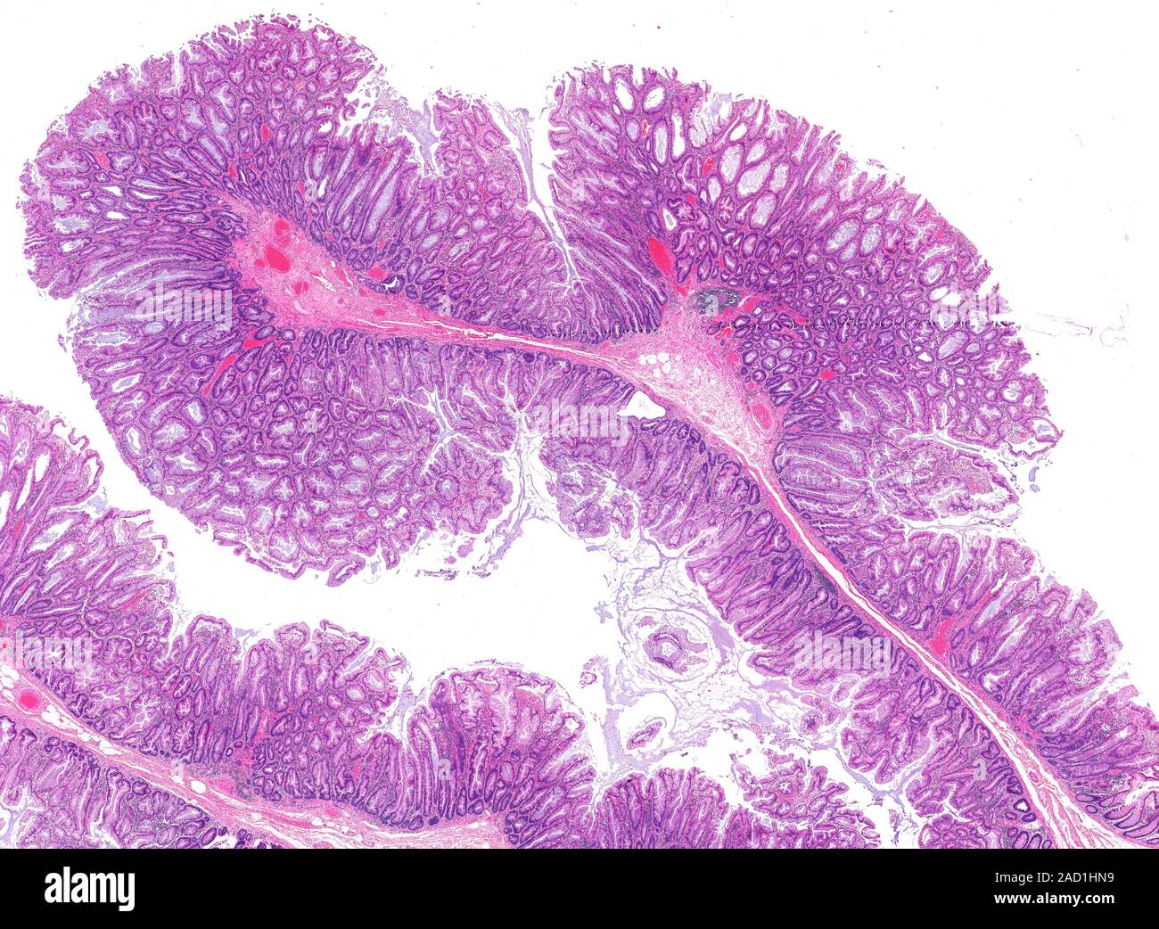 Light microscopy of a tumour of the human large bowel. This is a polyp ...
