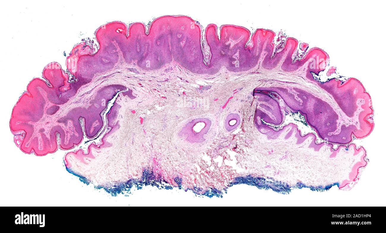 Light microscopy of skin benign growth called a seborrhoeic keratosis ...