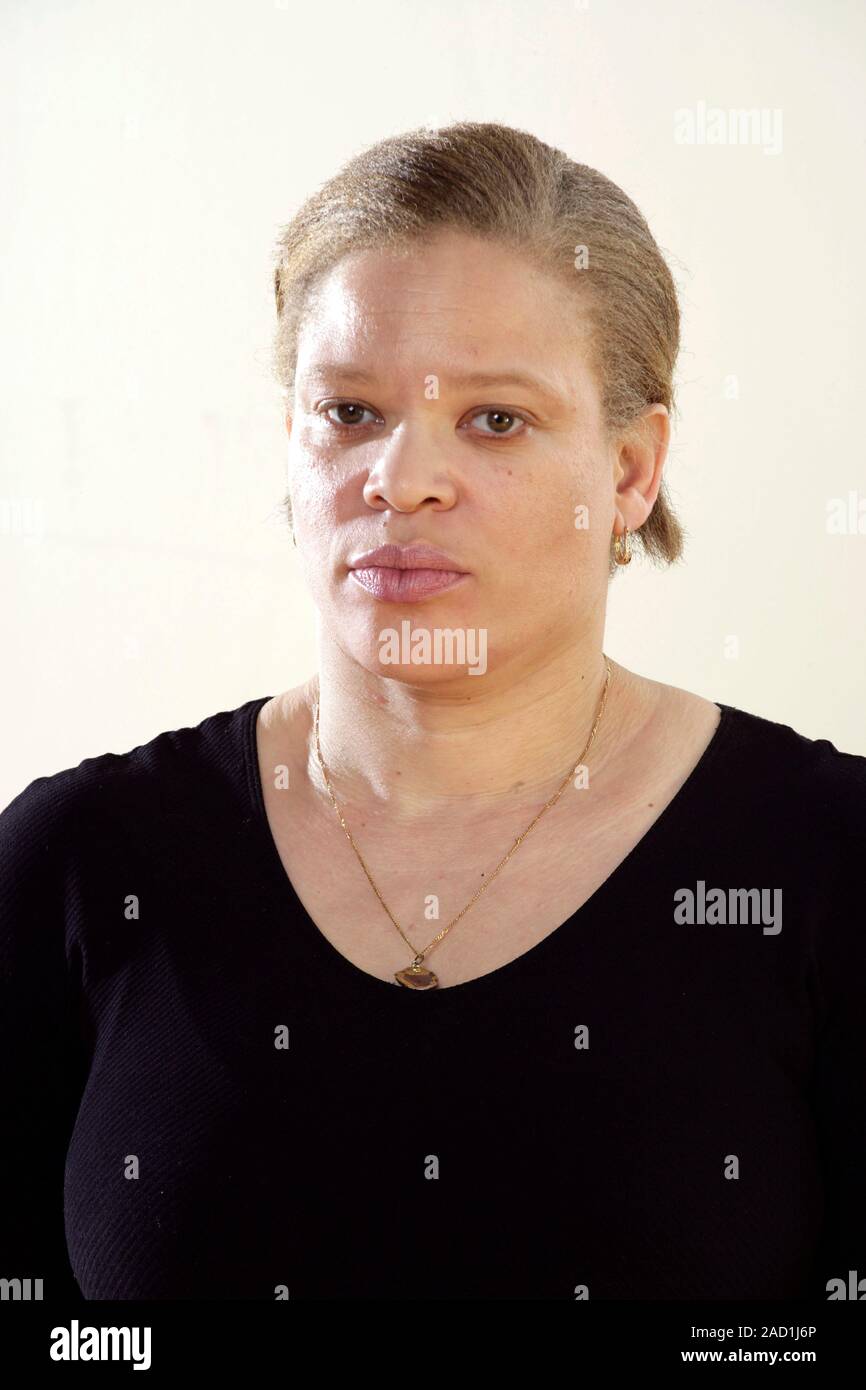 Albinism. Woman with the genetic condition of albinism. This results in ...