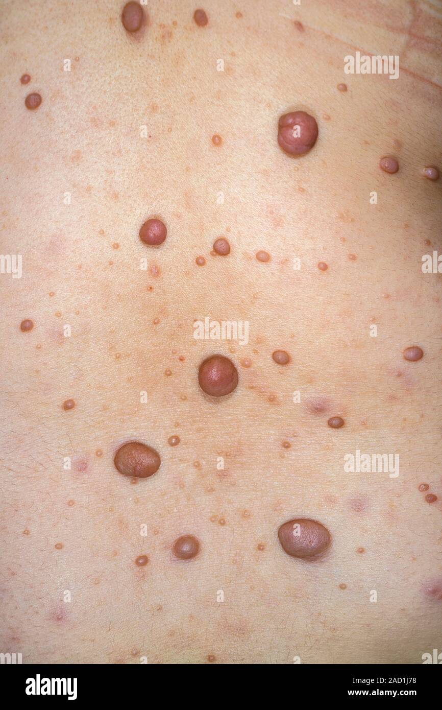 Neurofibromatosis. Neurofibroma growths on the back of a woman in her ...