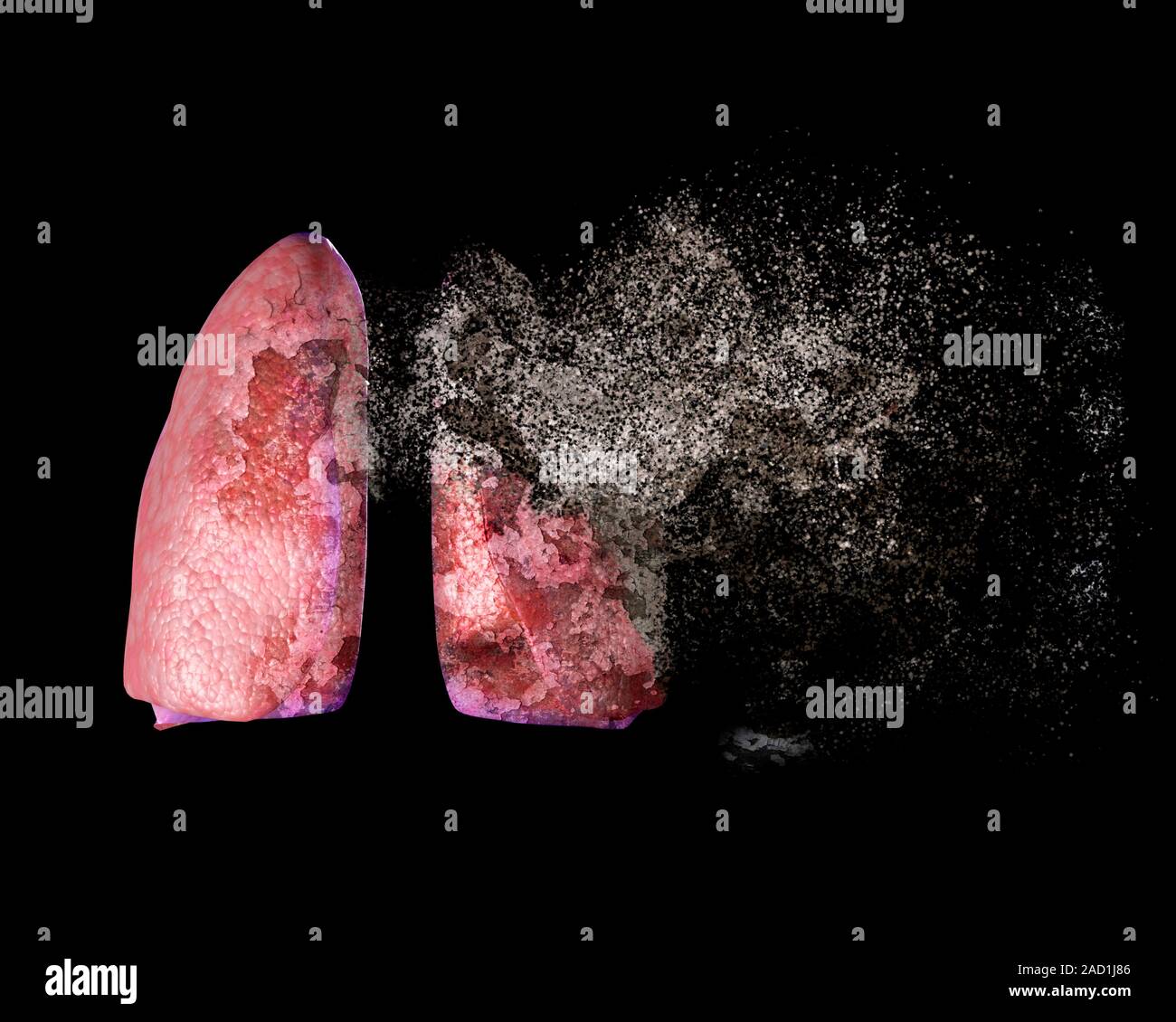 Lung disease. Conceptual illustration of a pair of human lungs with one ...