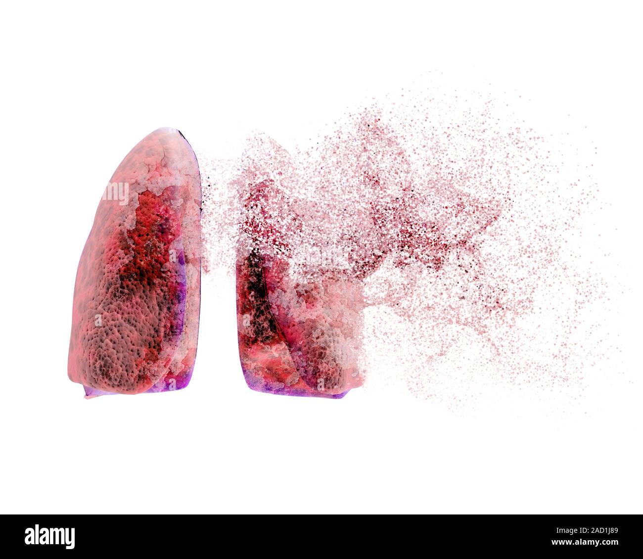 Lung disease. Conceptual illustration of a pair of human lungs with one ...