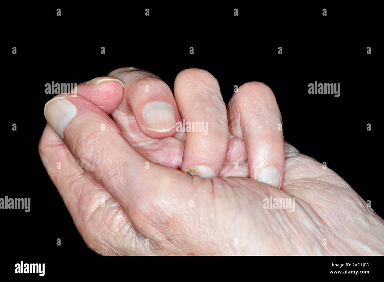 Dupuytren's contracture in the hand of an 85-year-old man. This ...