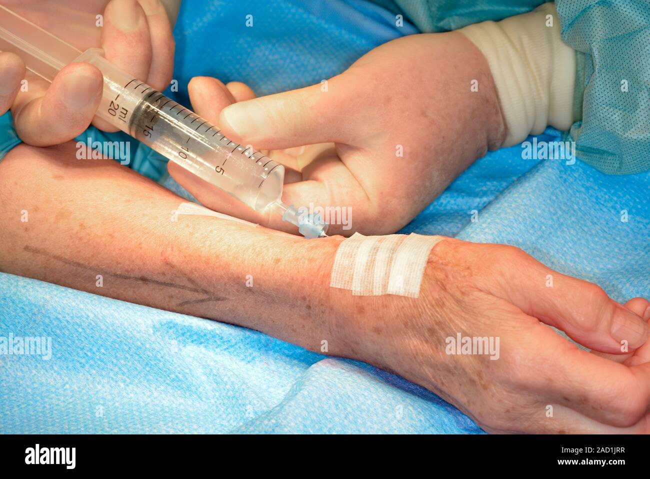 Trapeziumectomy wrist operation. Surgeon injecting local anaesthetic to ...