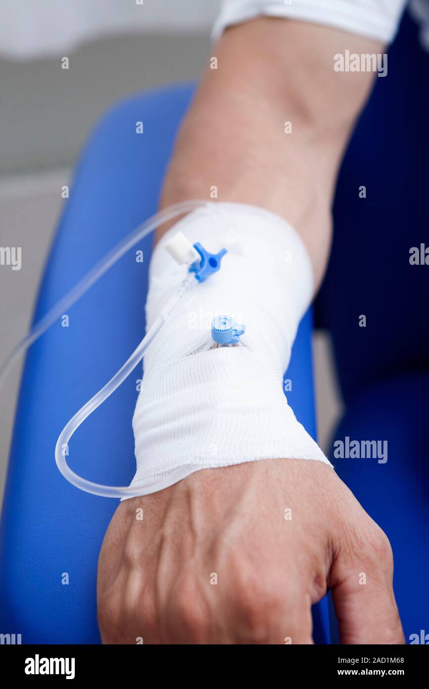 Chemotherapy treatment. Close-up of a cannula in the arm of a cancer ...