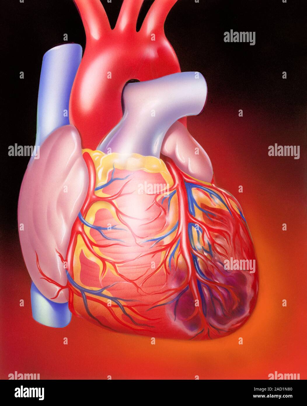 Myocardial infarction. Illustration of a heart with a large area of ...