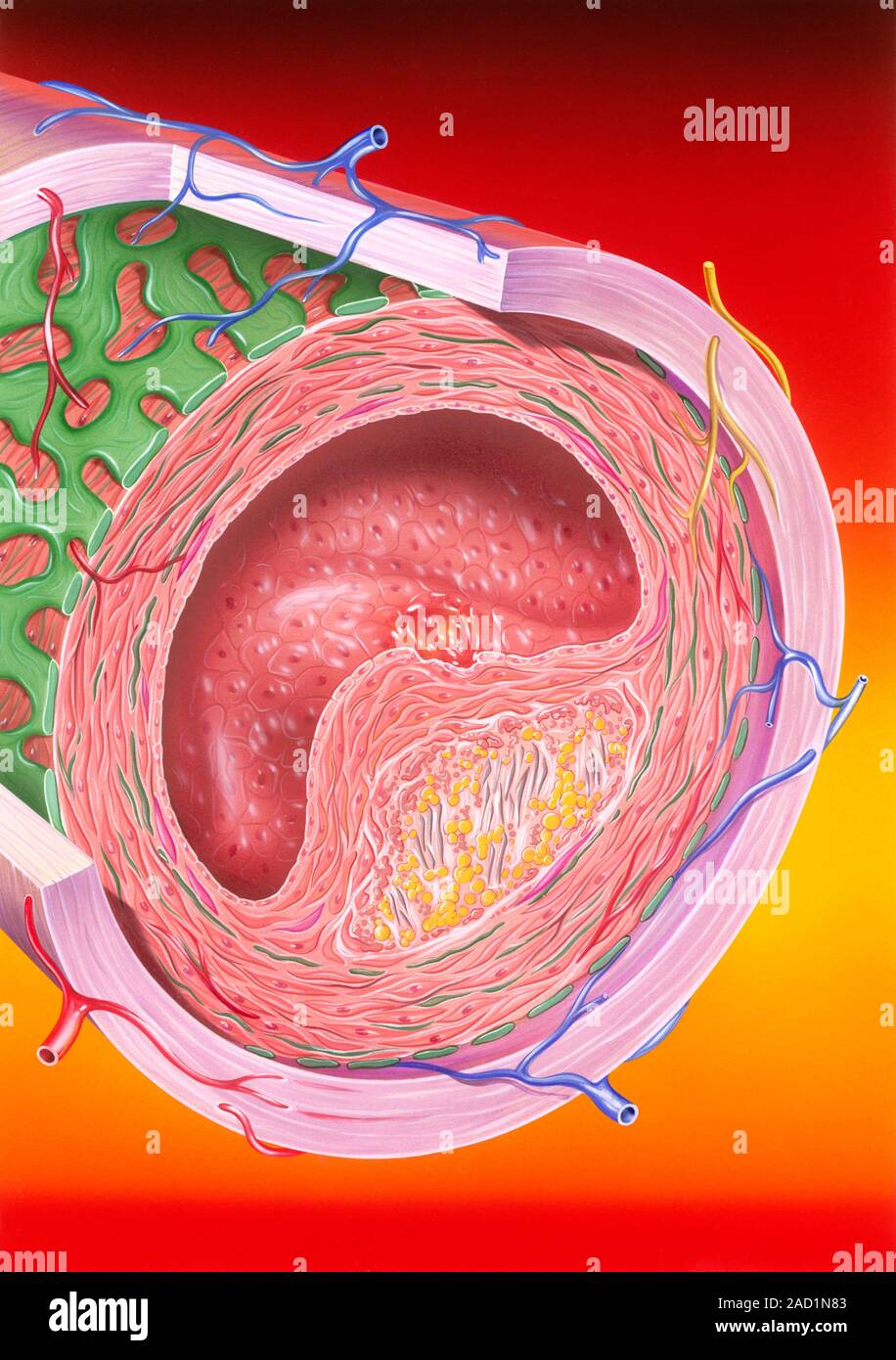 Atherosclerosis. Illustration of a cross-section through an artery that ...