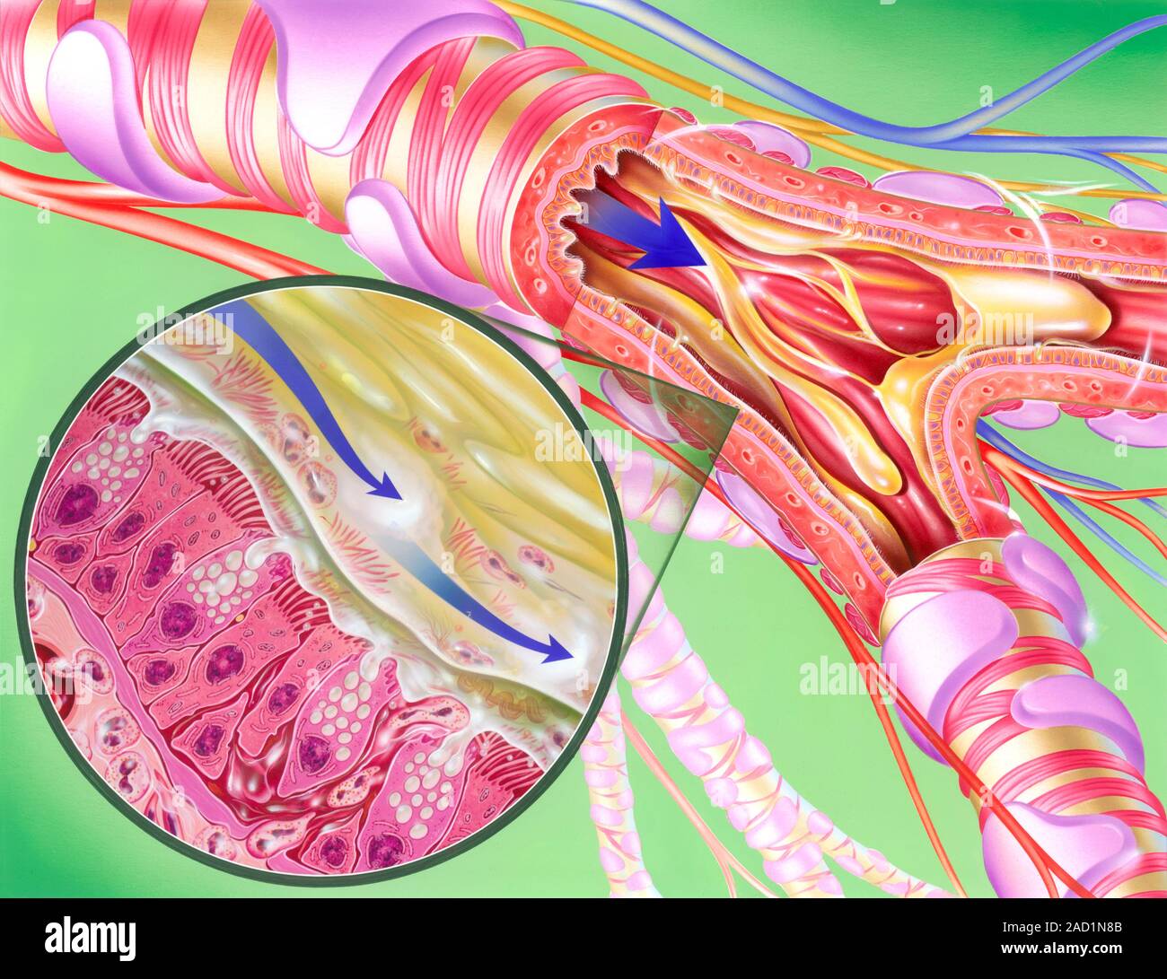 Chronic obstructive pulmonary disease. Illustration of the bronchi ...