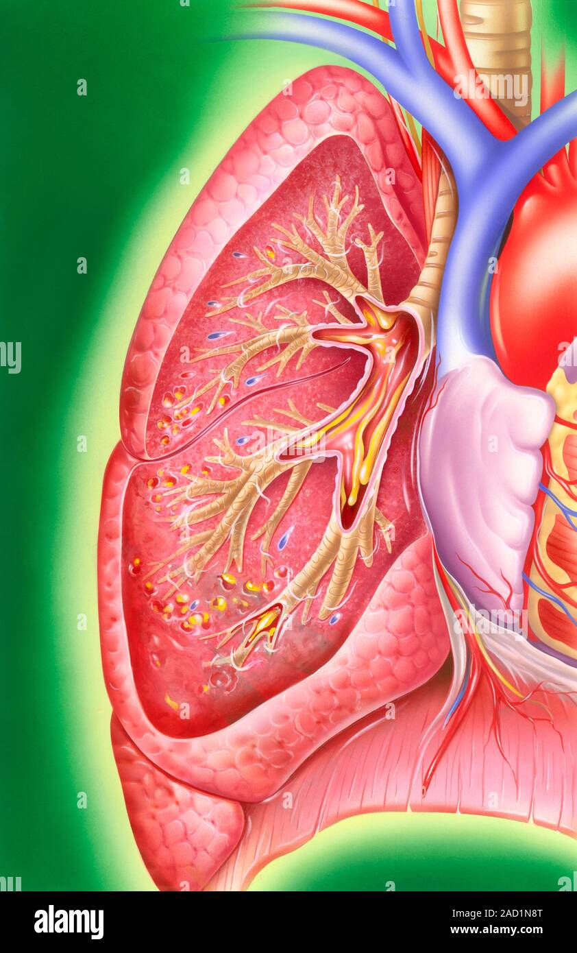 Obstructive lung disease. Illustration of the right lung in obstructive ...