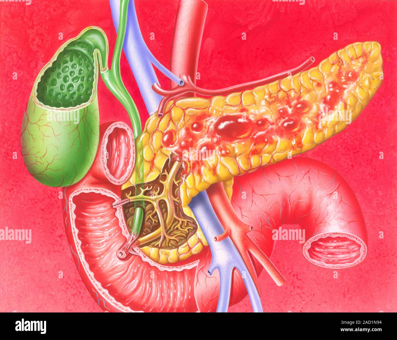 Pancreatitis. Illustration of pancreatitis, inflammation of the ...