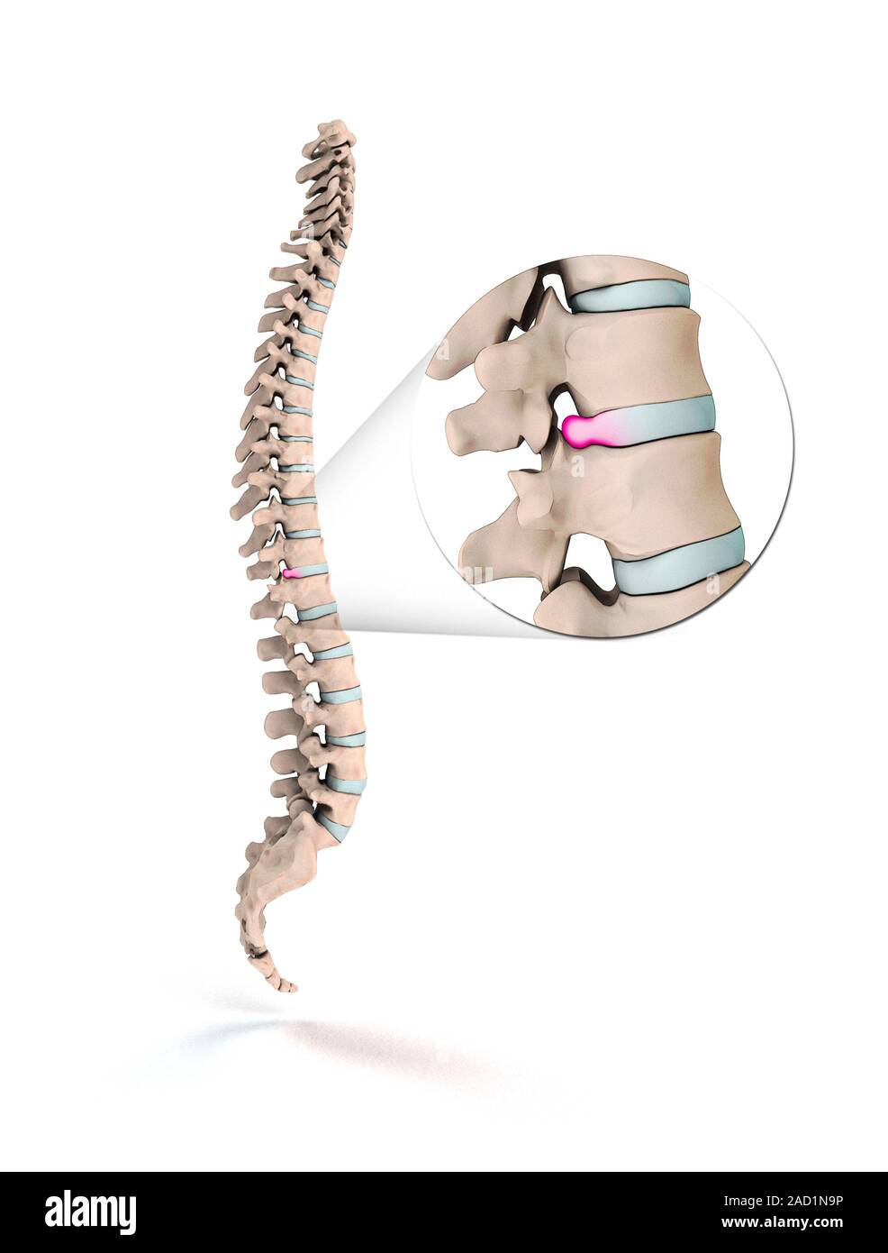 Slipped intervertebral disc. Computer illustration of a side view of ...