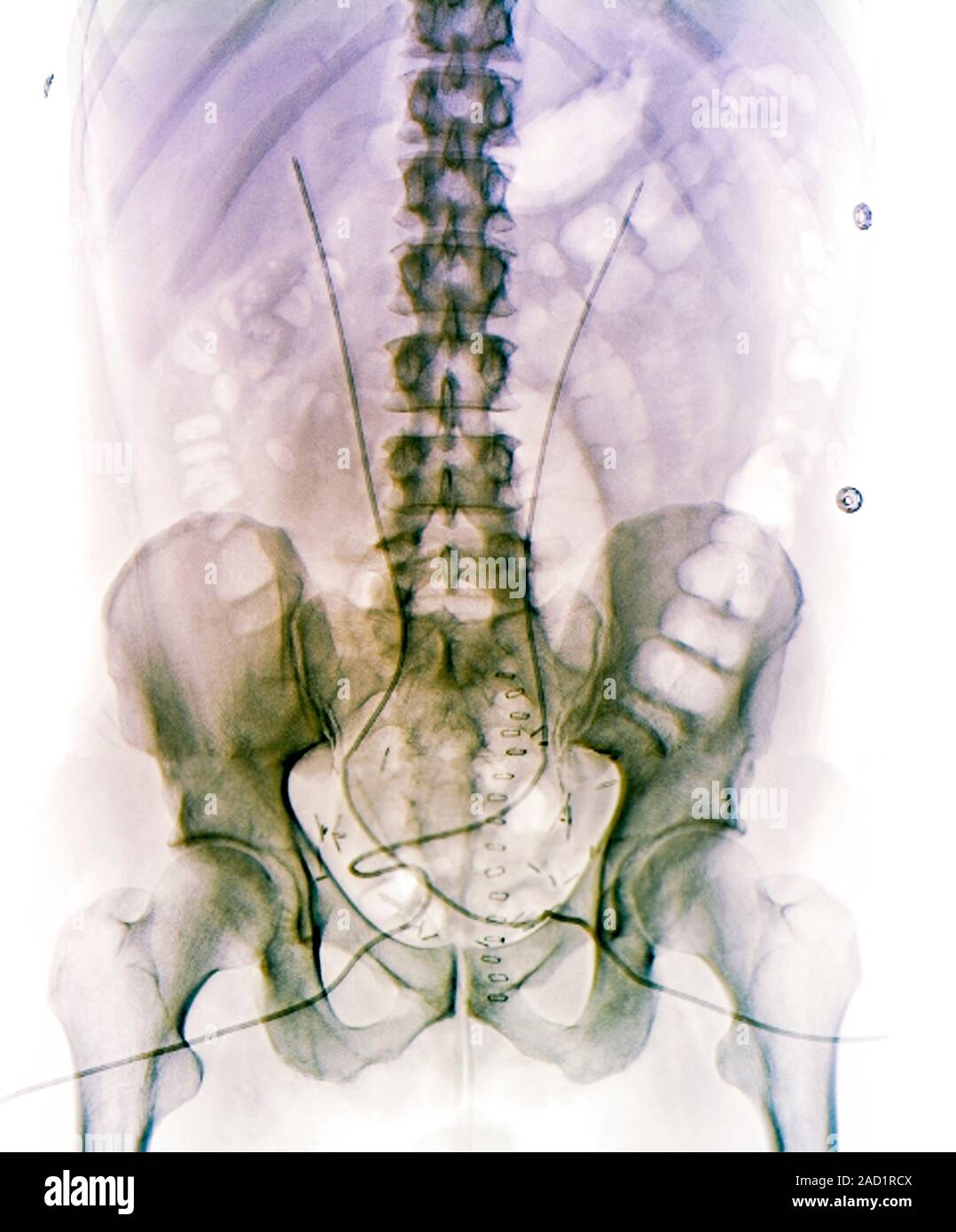 Post-operative bladder cancer. Coloured X-ray of a section through the ...