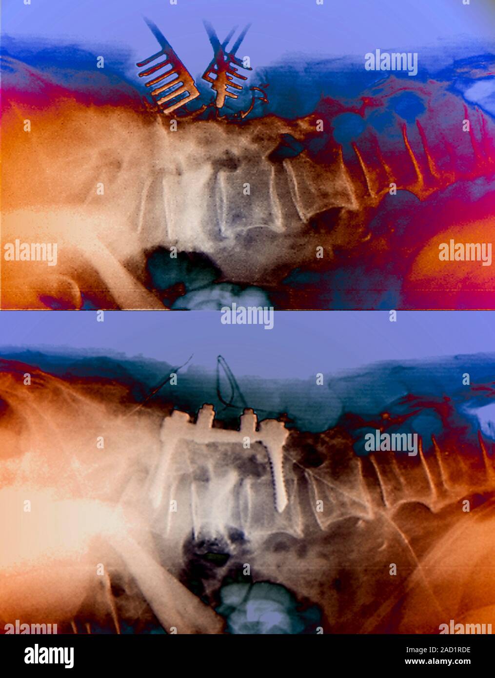 Spinal compression fractures in surgery. Coloured X-rays of sections ...
