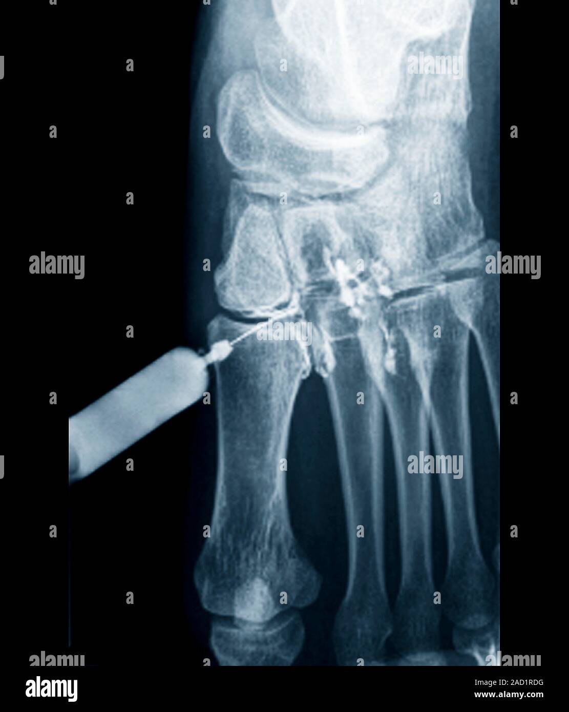 Foot pain being treated, X-ray of a section through the foot of a 30 ...