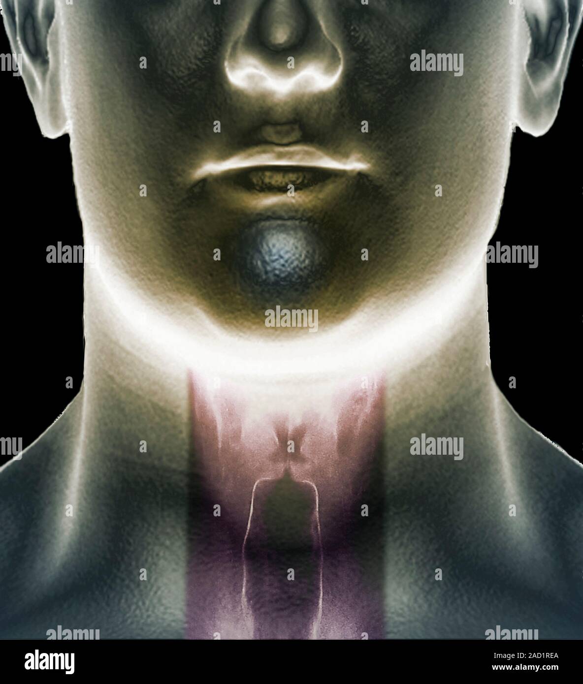 Vocal cords. Composite image of a 3D computer artwork of a human head ...