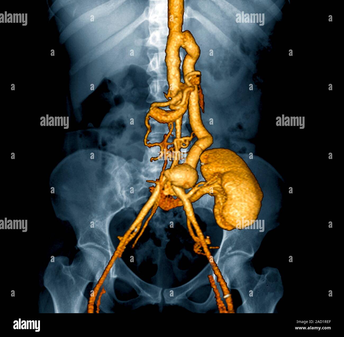 Takayasu's arteritis. Coloured 3D computed tomography (CT) angiogram of ...