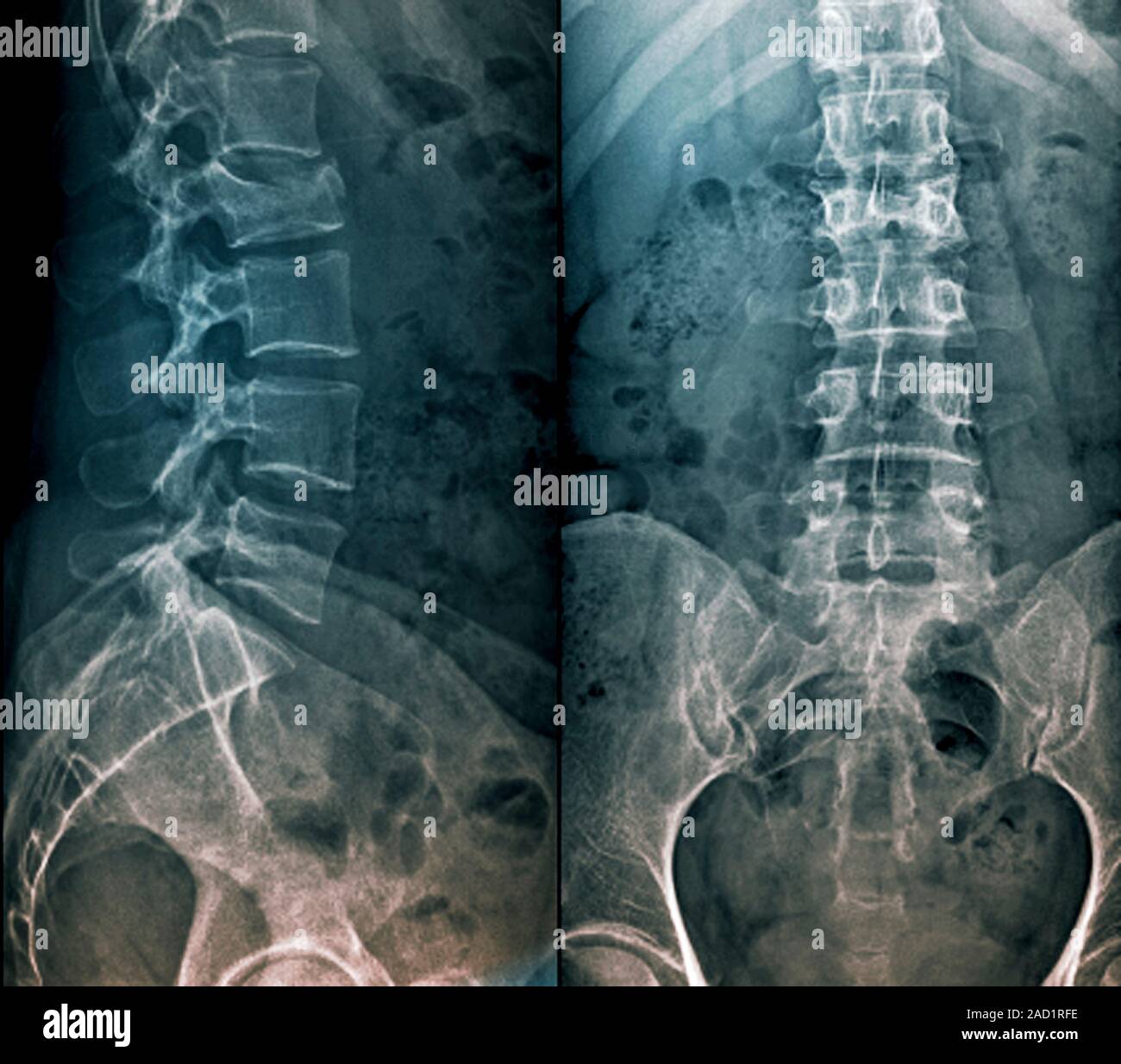 Untreated fractured vertebra. Coloured X-rays of sections through the ...