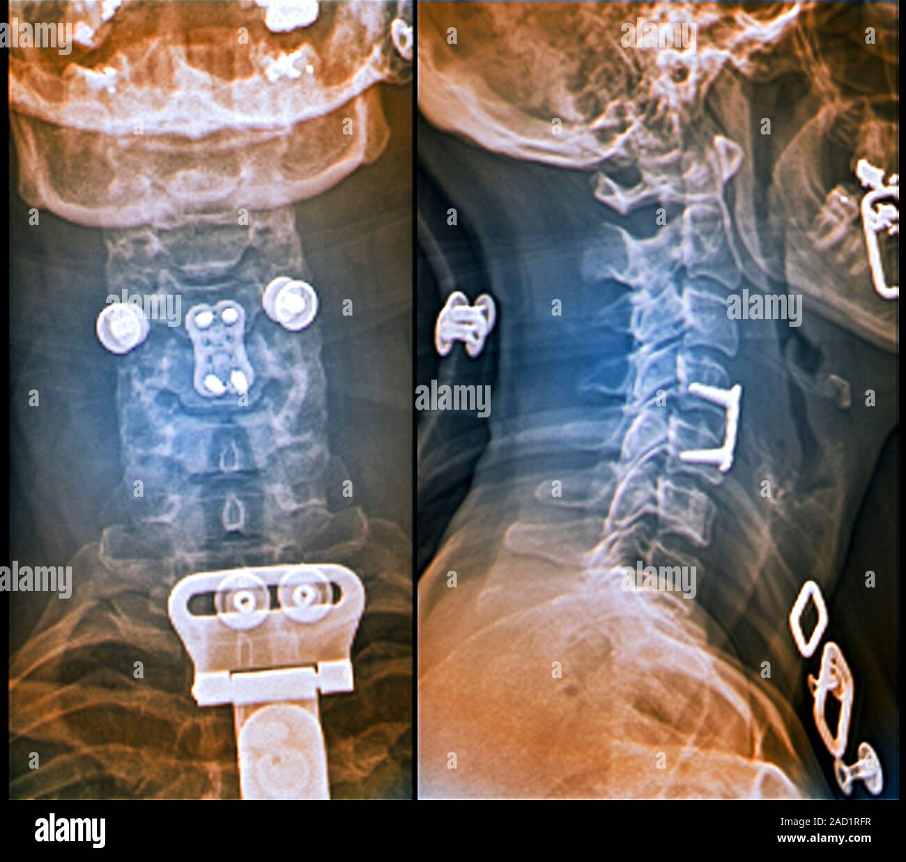 Herniated spinal disc after treatment. Coloured frontal (left) and ...