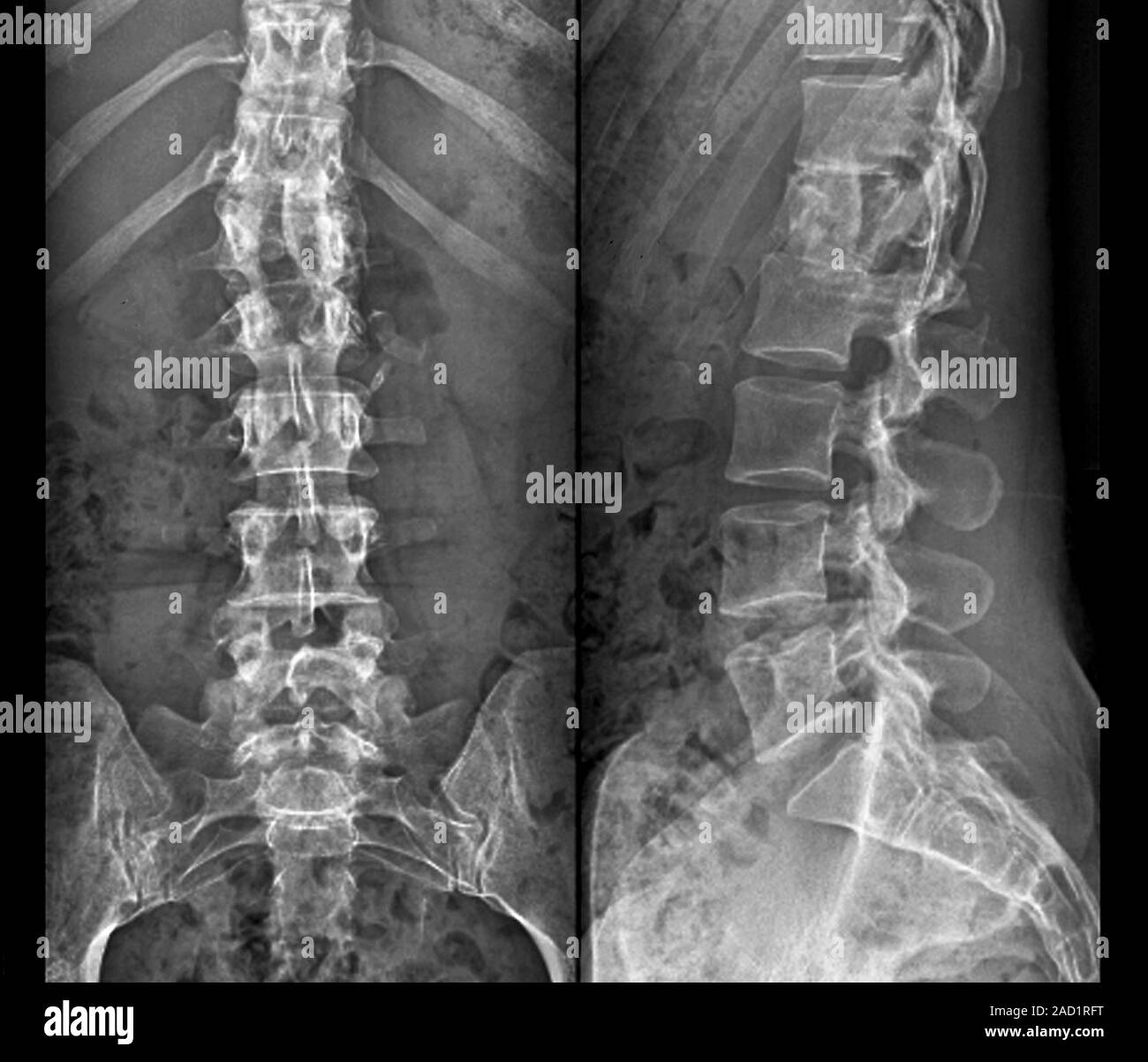 Fixed spinal fracture. Frontal (left) and profile (right) X-rays of a ...