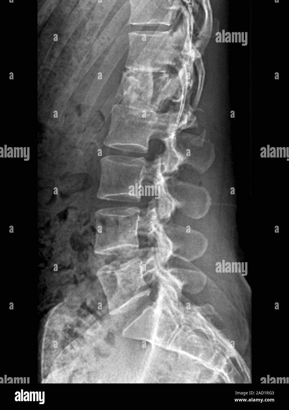 Fixed spinal fracture. X-ray of a section through the lower (lumbar ... Fixed spinal fracture. X-ray of a section through the lower (lumbar ...