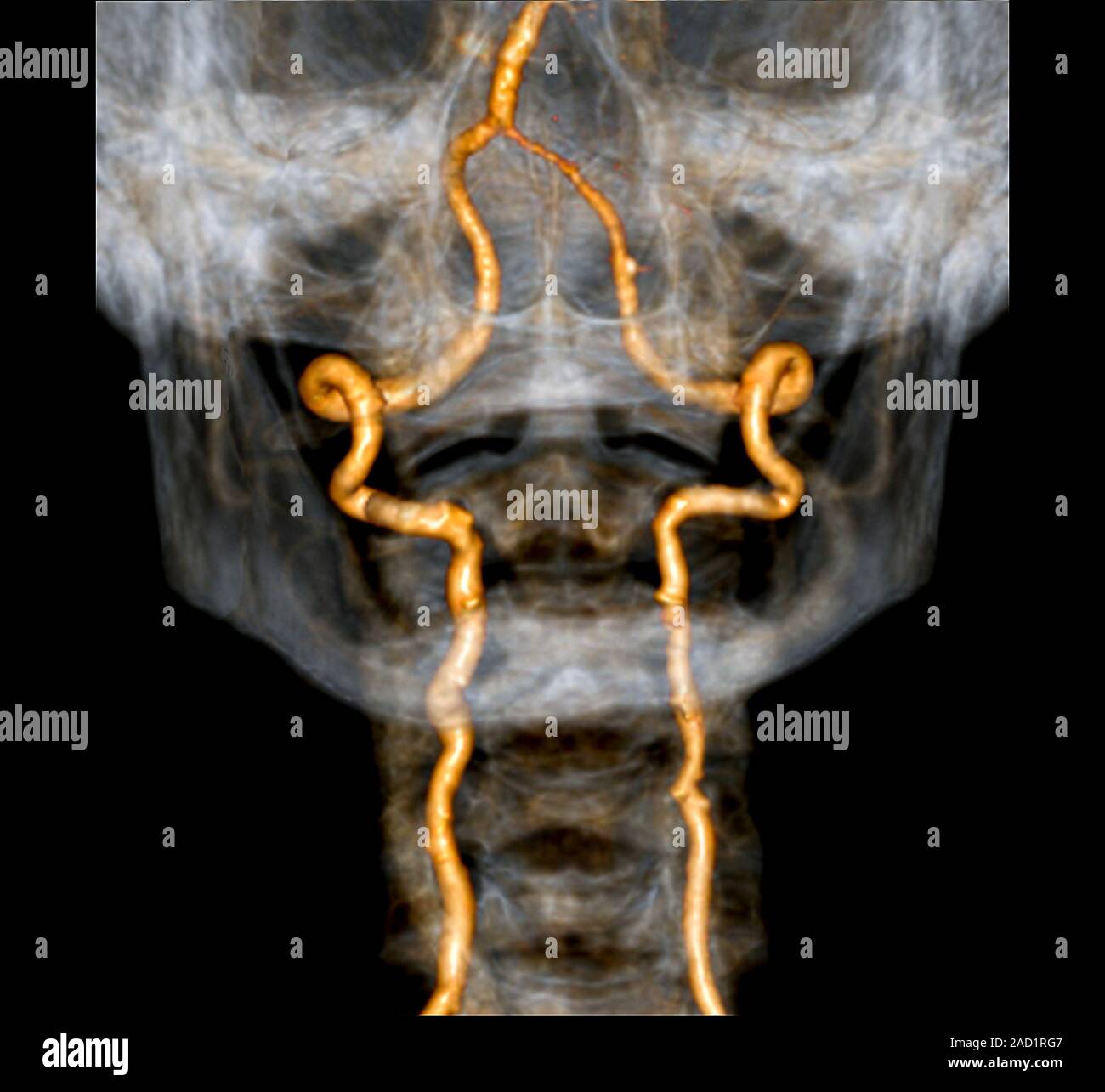 Vertebral artery insufficiency. Coloured 3D computed tomography (CT ...