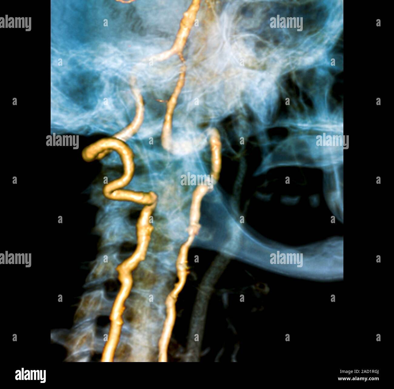 Vertebral artery insufficiency. Coloured 3D computed tomography (CT ...