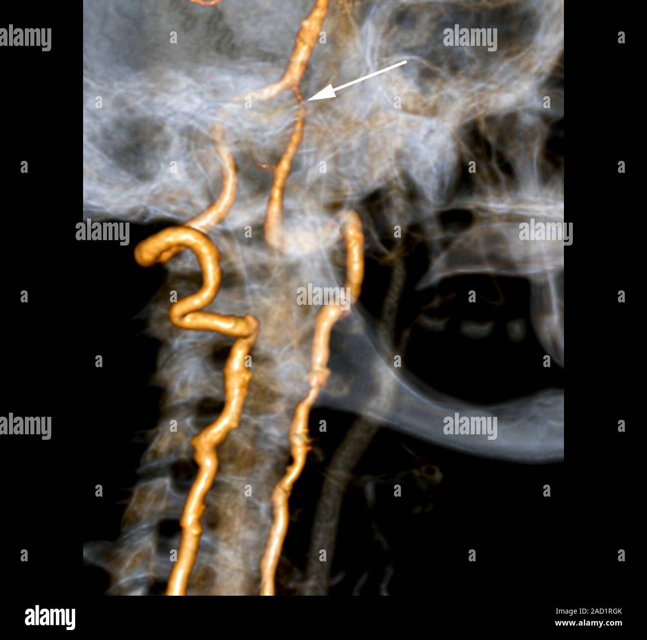 Vertebral artery insufficiency. Coloured 3D computed tomography (CT ...