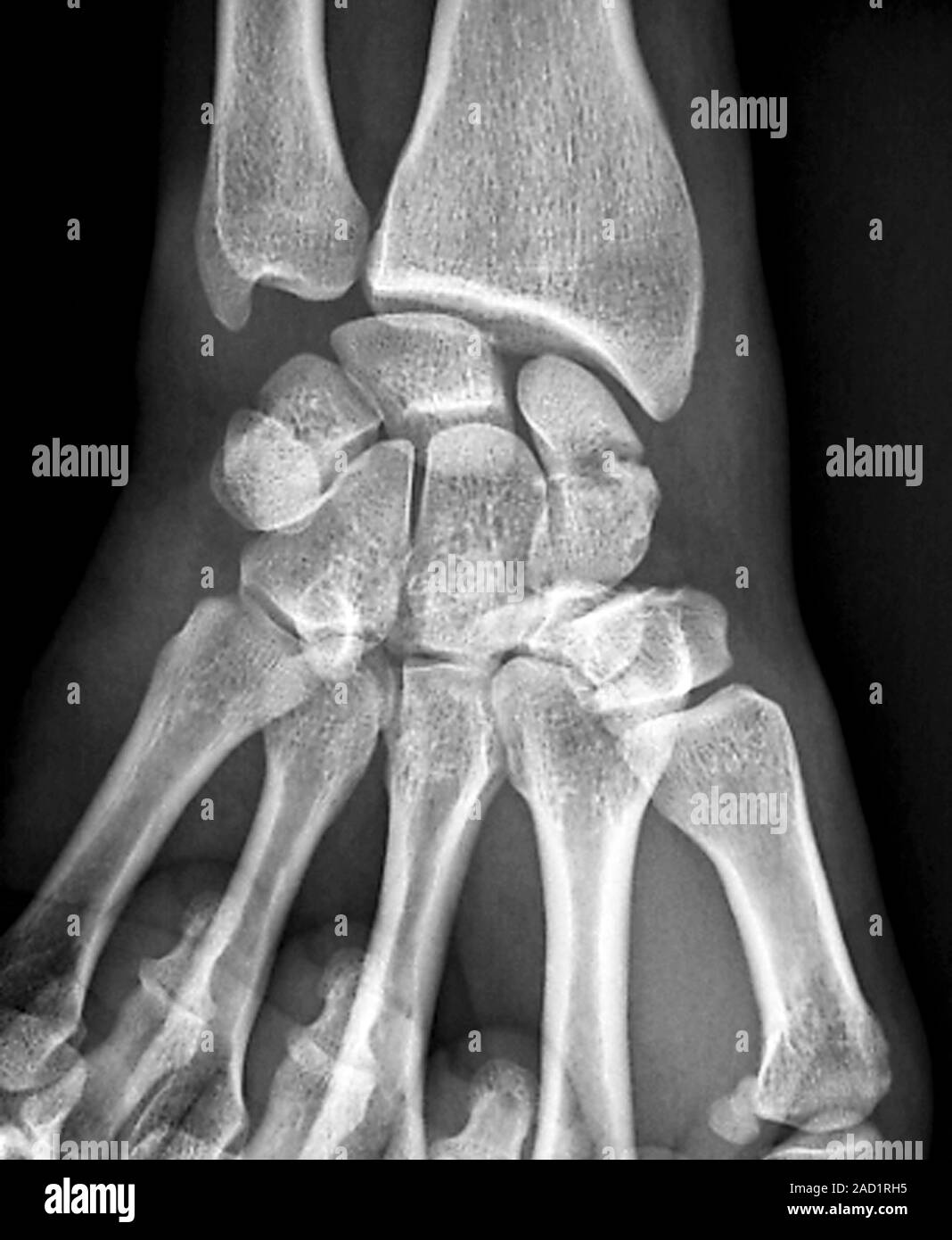Wrist fracture. X-ray of the wrist of a 30-year-old patient with a ...