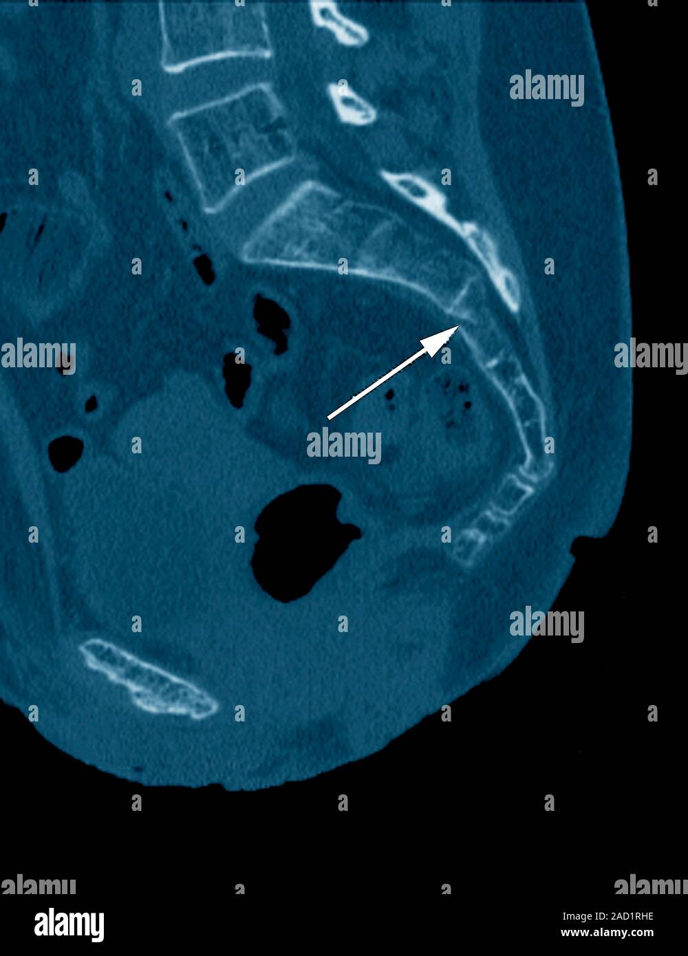 Fractured Pelvis Computed Tomography Ct Scan Of A Section Through