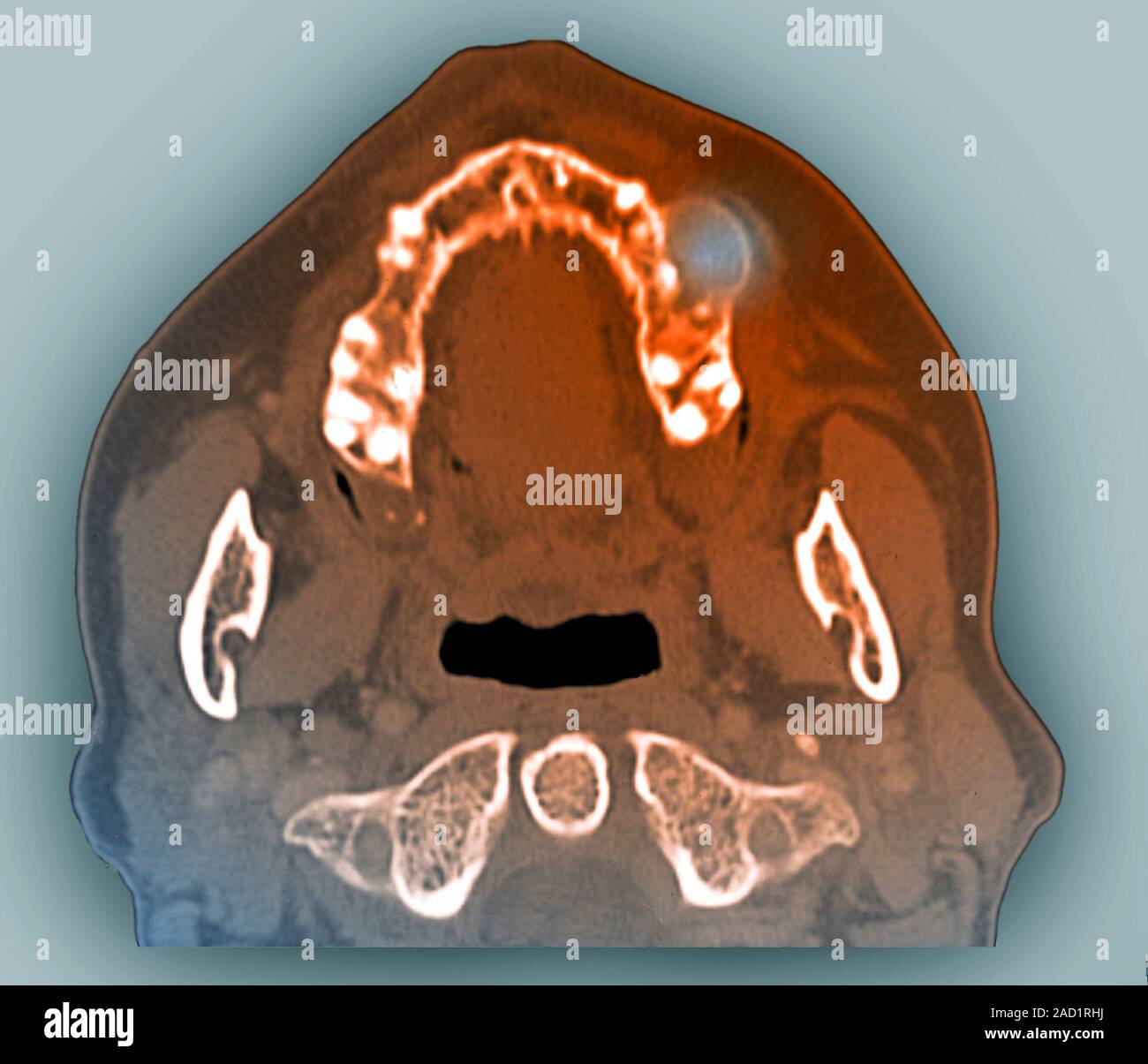 Giant cell granuloma of the jaw. Coloured computed tomography (CT) scan ...
