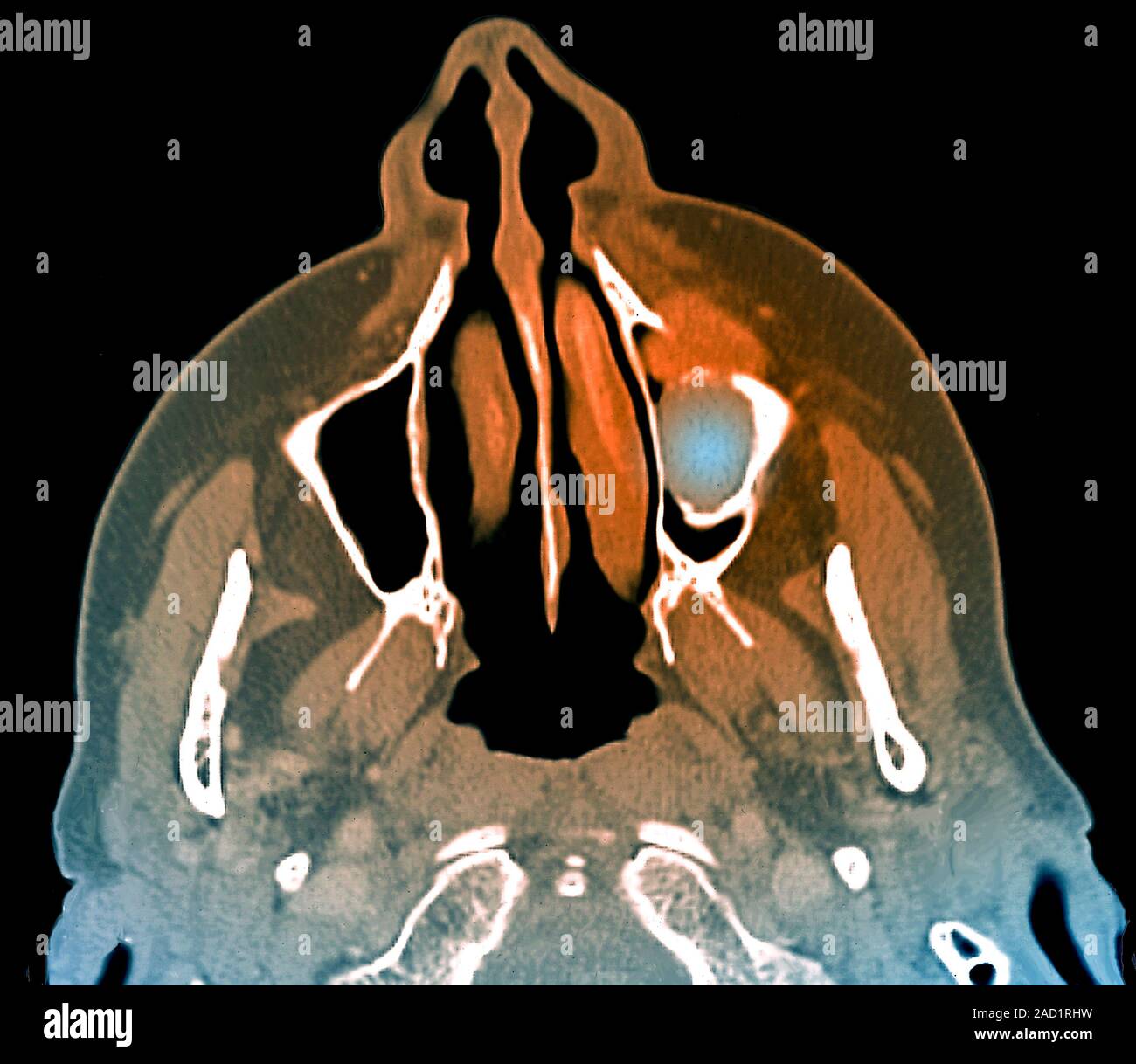 Giant cell granuloma of the jaw. Coloured computed tomography (CT) scan ...